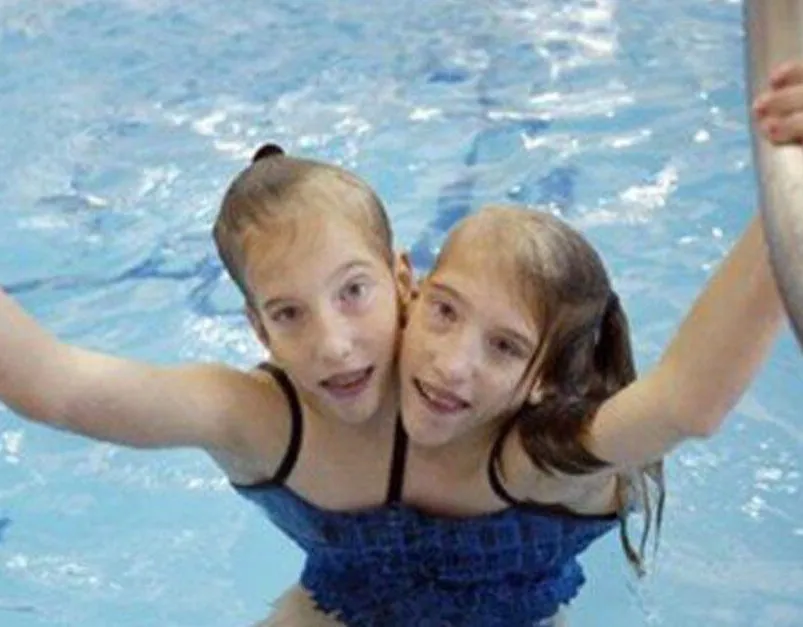 The Incredible Story Of Abby And Brittany Hensel Femanin